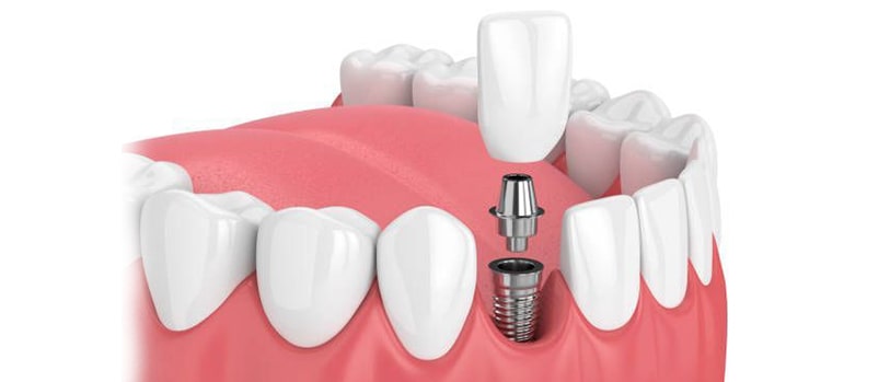 SINGLE TOOTH IMPLANT PROCESS - dental implant solutions