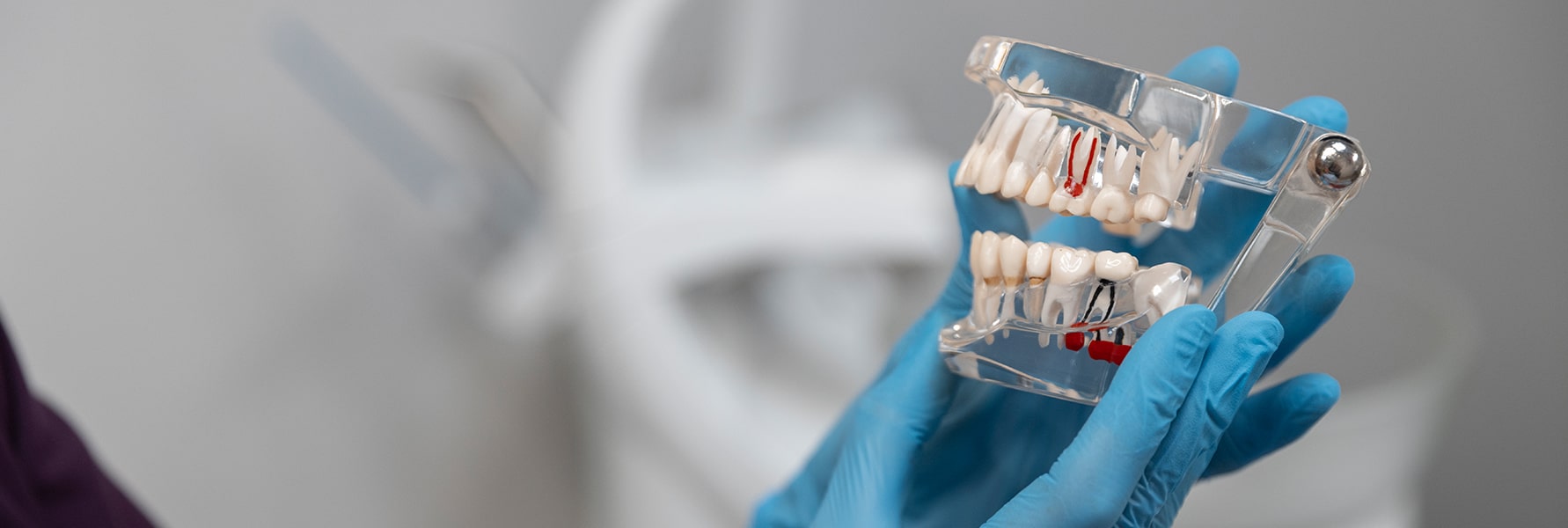 Socket Preservation - dental implant solutions